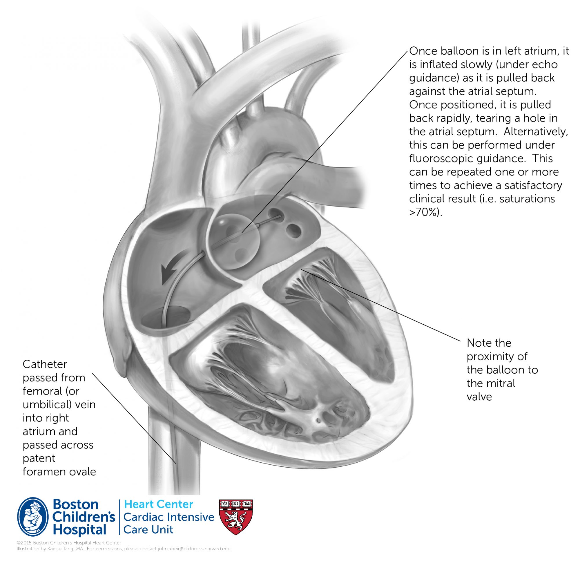 dTGA/IVS – Supplement to the Boston Children's Hospital Cardiac ICU ...