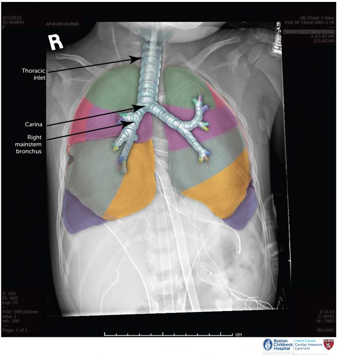Interpreting a CXR – Online supplement