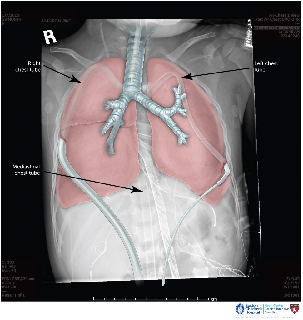 Interpreting a CXR – Online supplement