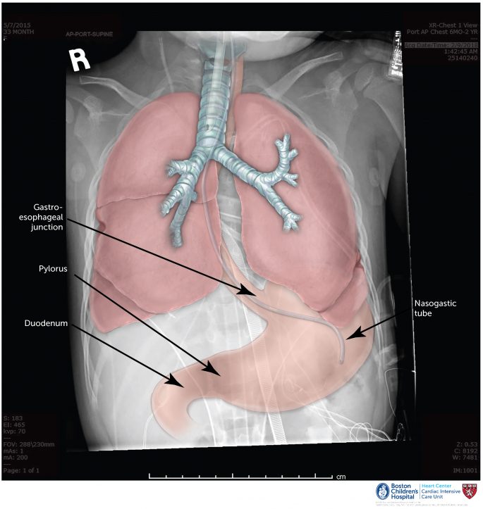 Interpreting a CXR – Online supplement