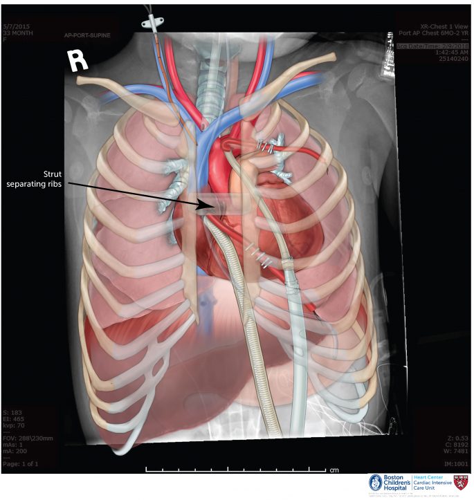 Interpreting a CXR – Online supplement