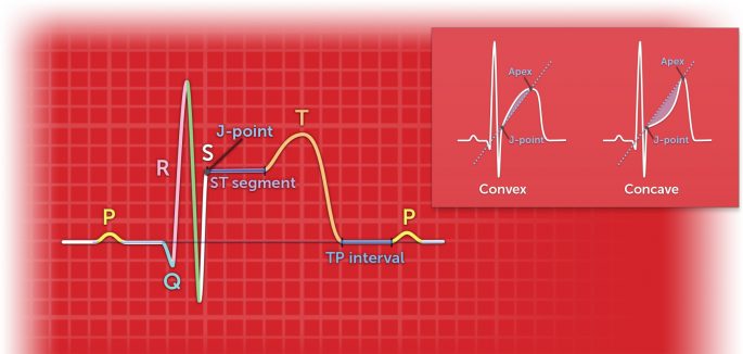 Interpreting an EKG – Online supplement