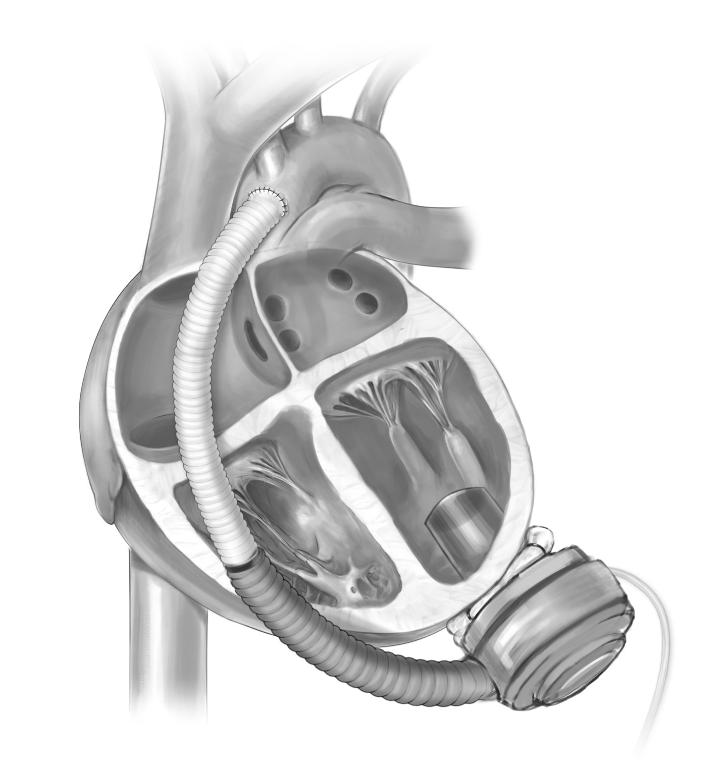 HeartMate III – Online supplement