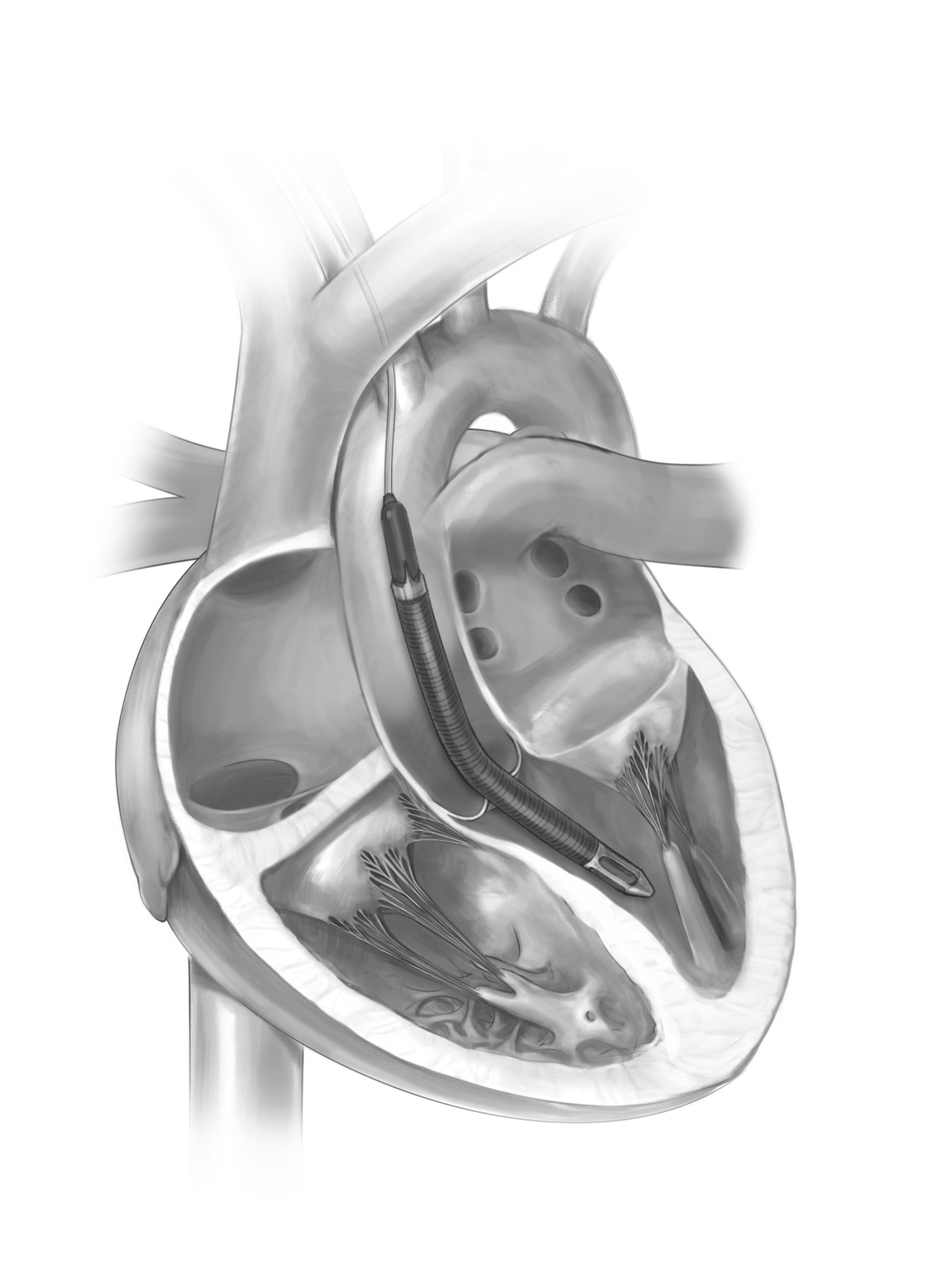 Impella 5.5 – Online supplement