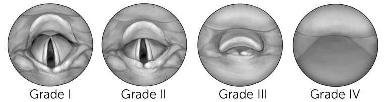 Tracheal intubation – Online supplement