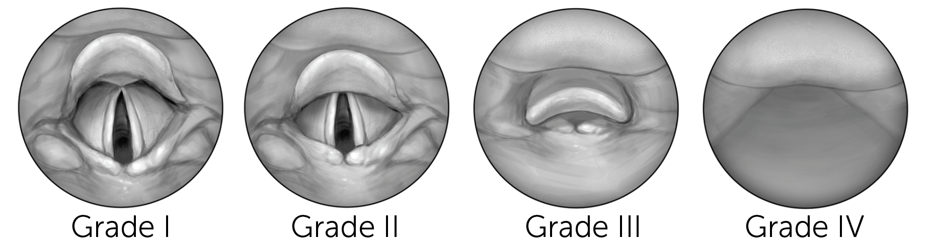 Tracheal intubation – Online supplement