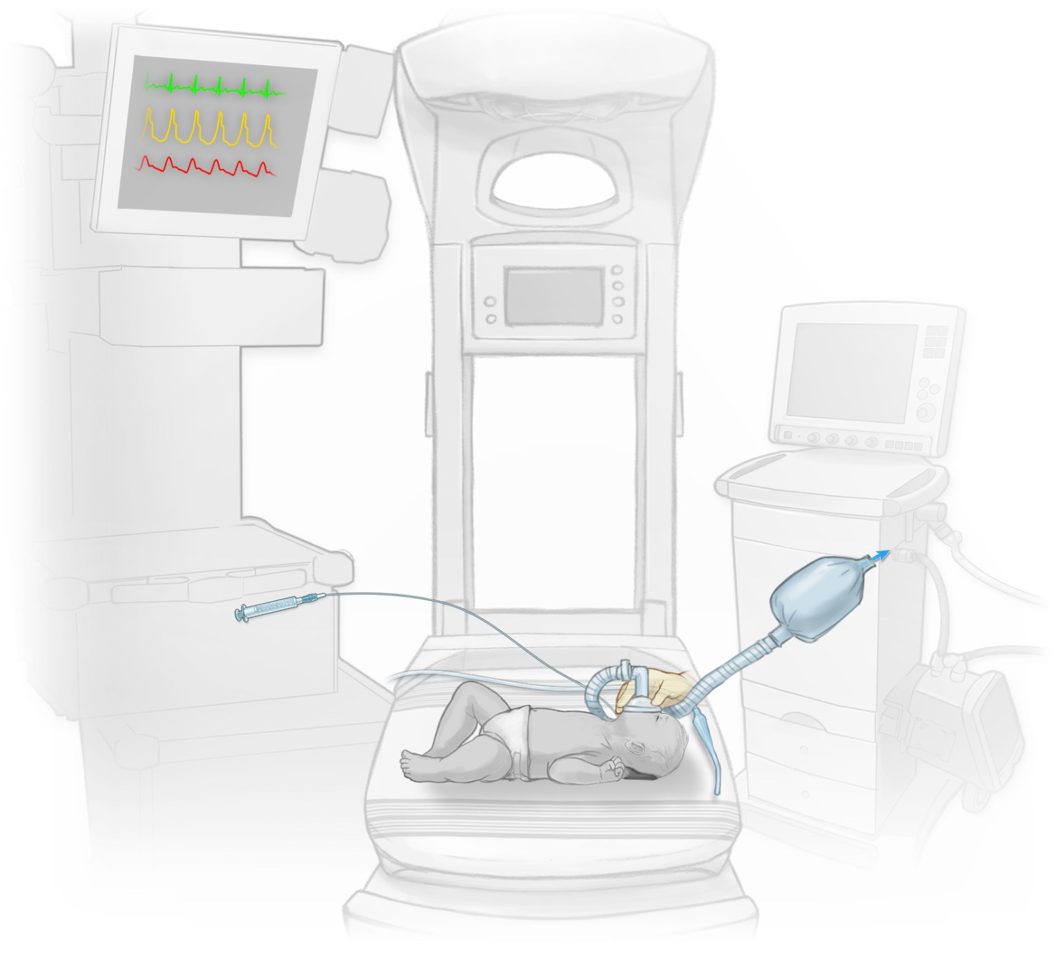 Tracheal intubation – Online supplement