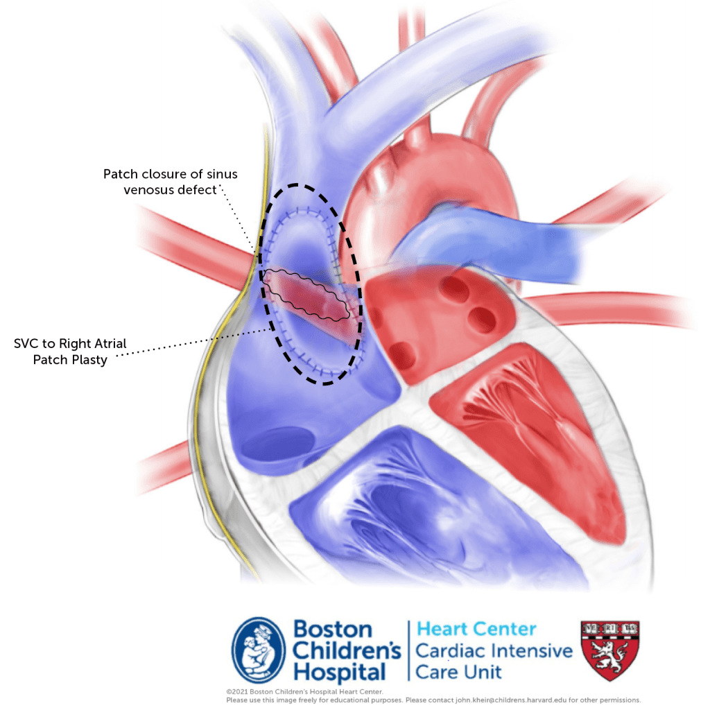 2-patch-repair-of-PAPVC-1 – Online supplement