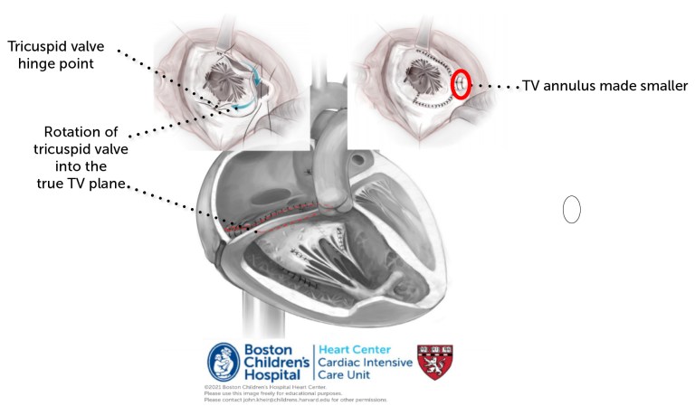 Ebstein’s anomaly – Online supplement