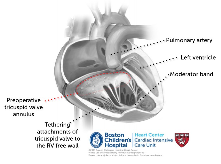 Ebstein’s anomaly – Online supplement
