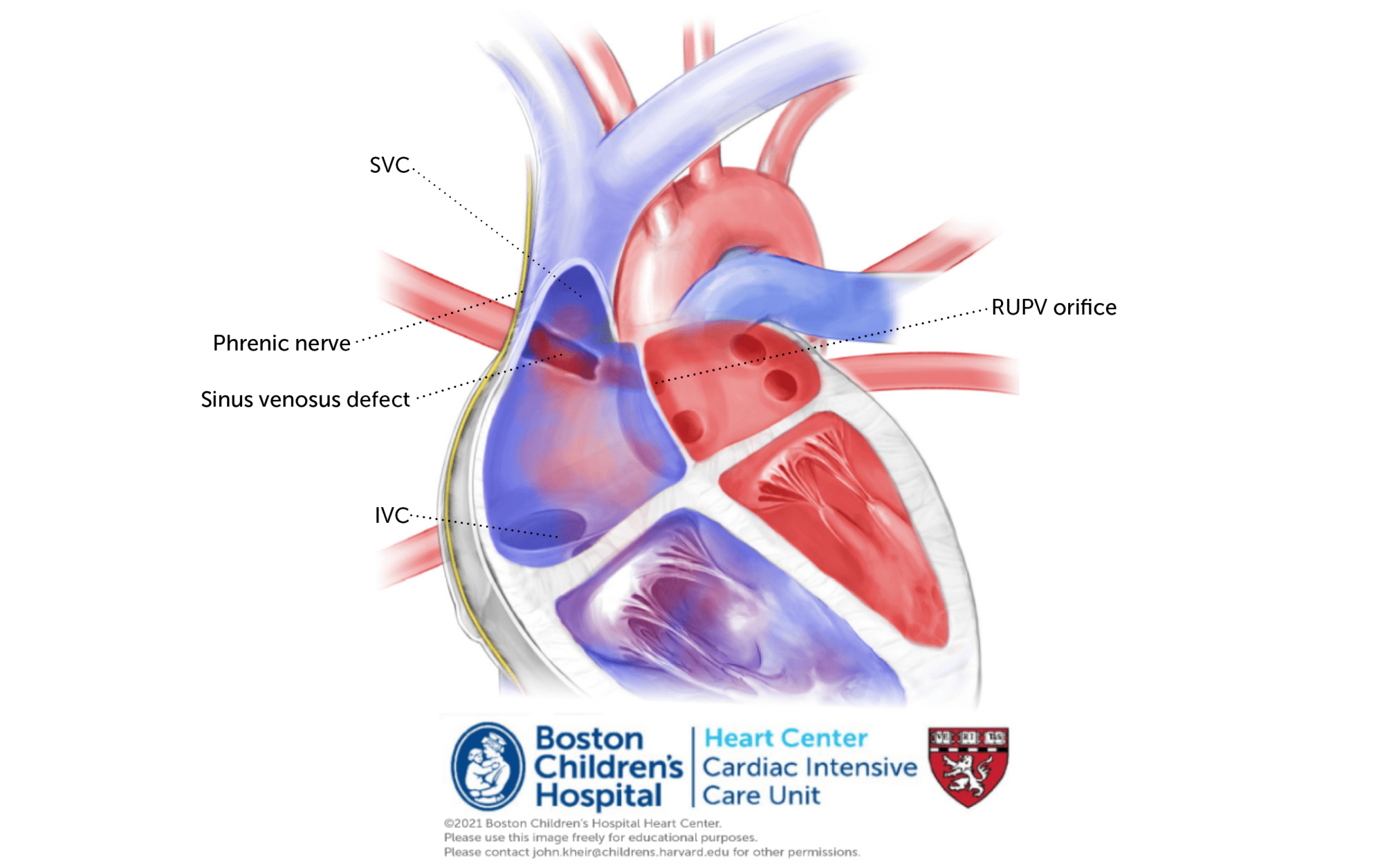 Sinus venosus ASD (PAPVR) – Online supplement