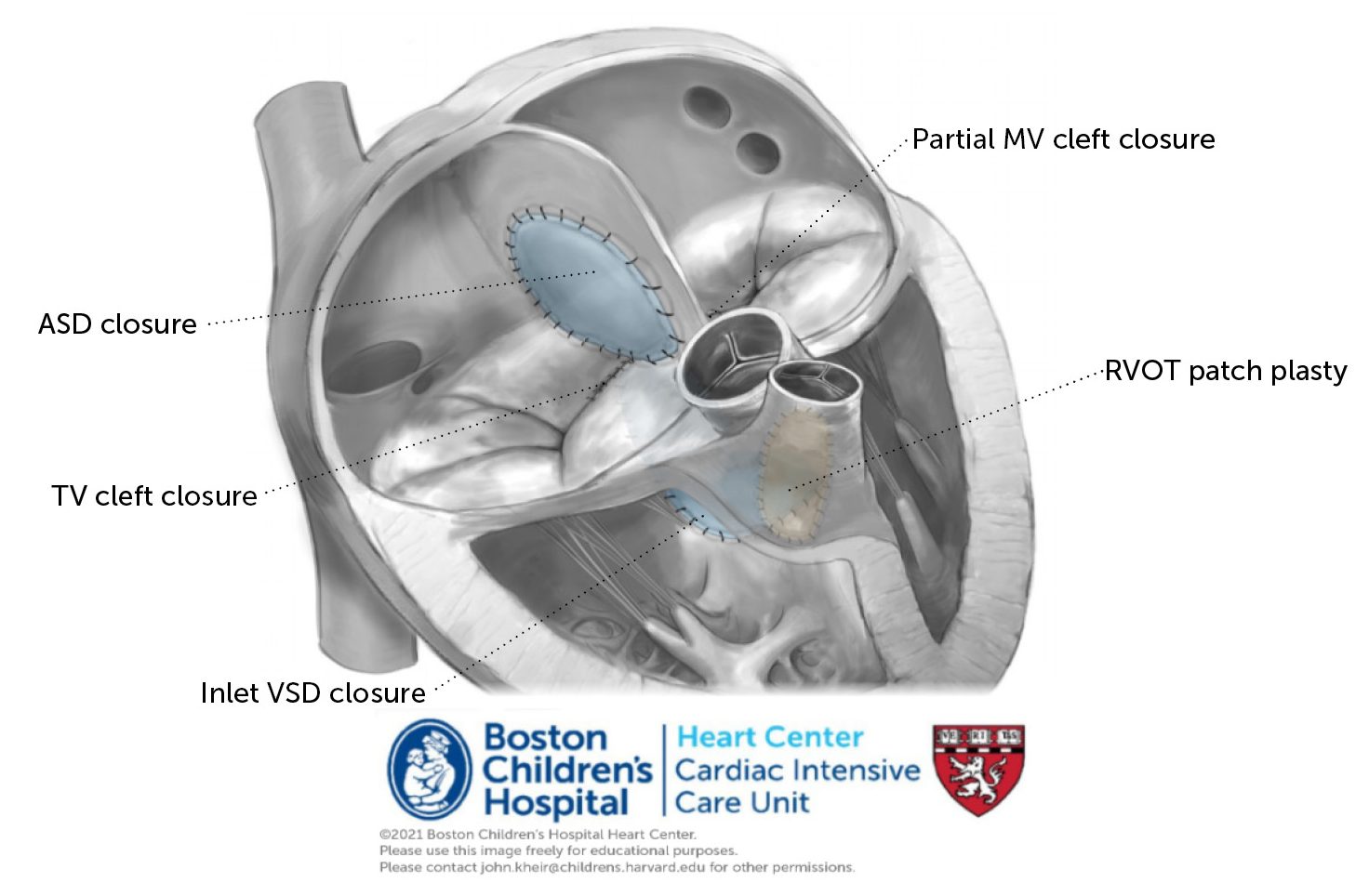 TOF/CAVC – Online supplement