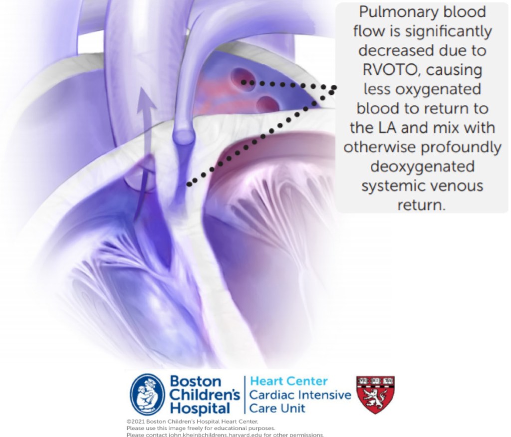 TOF/Hypercyanotic Spells – Online supplement