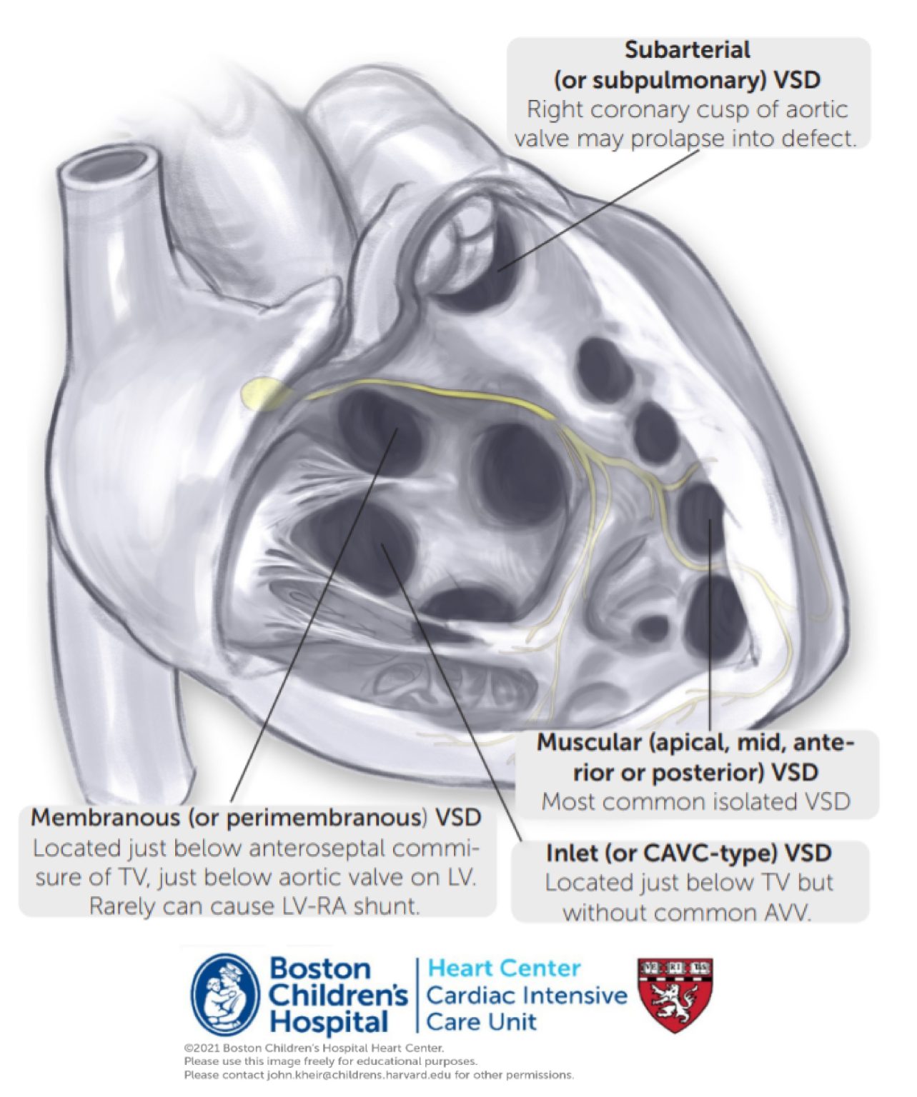 VSDs – Online supplement