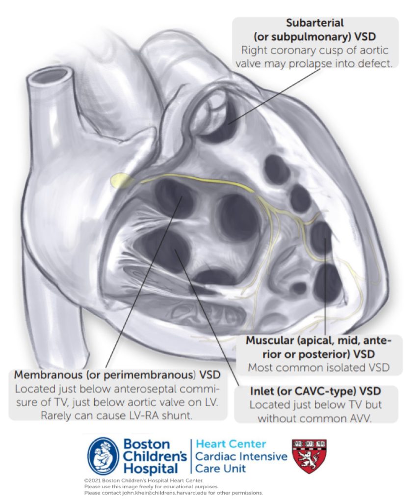VSDs – Online supplement