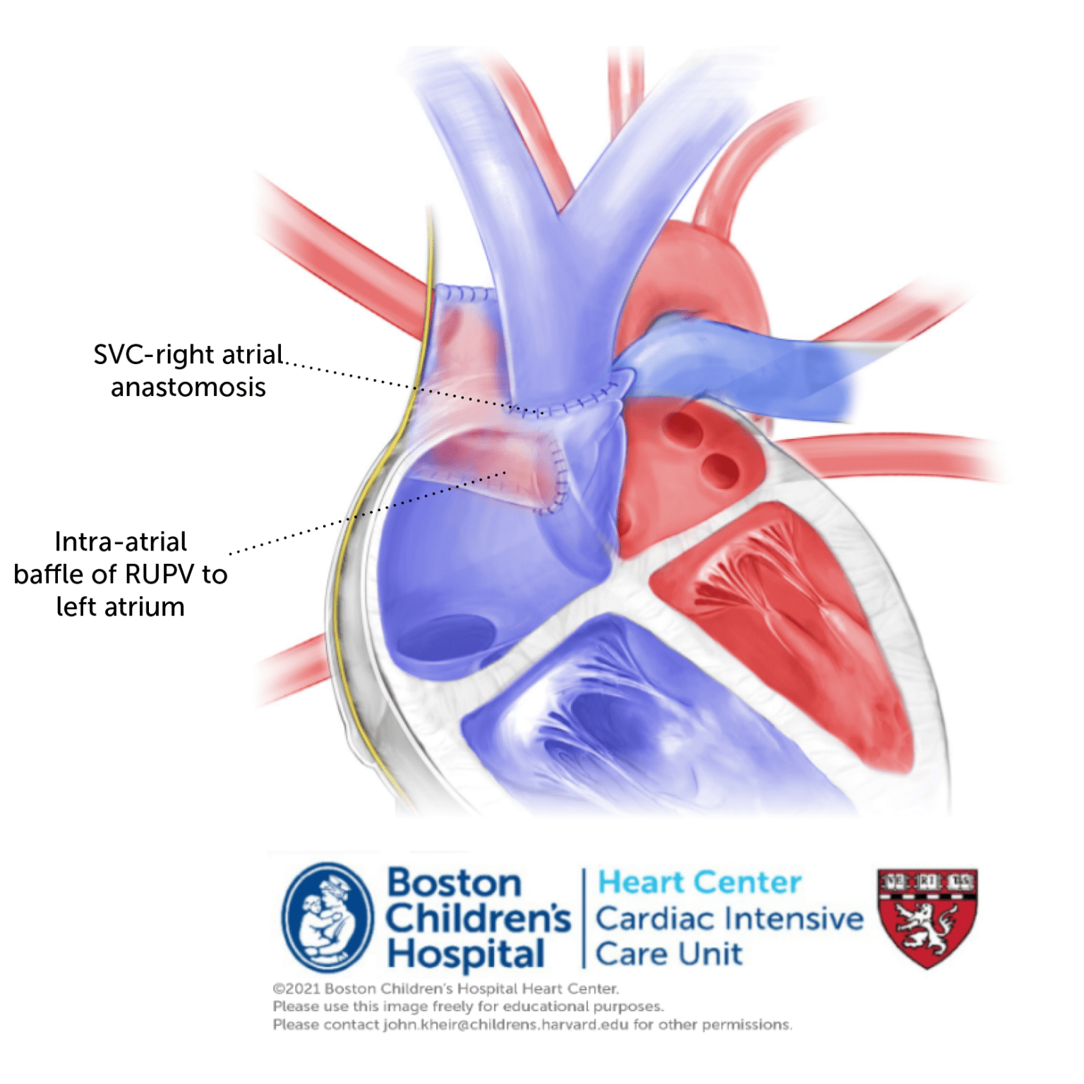 Sinus venosus ASD (PAPVR) – Online supplement