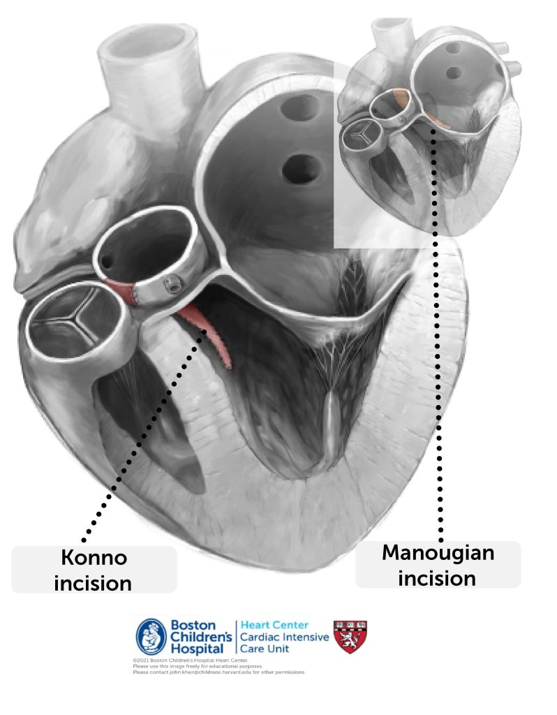 Ross Procedure/Aortic Root Enlargements – Online supplement
