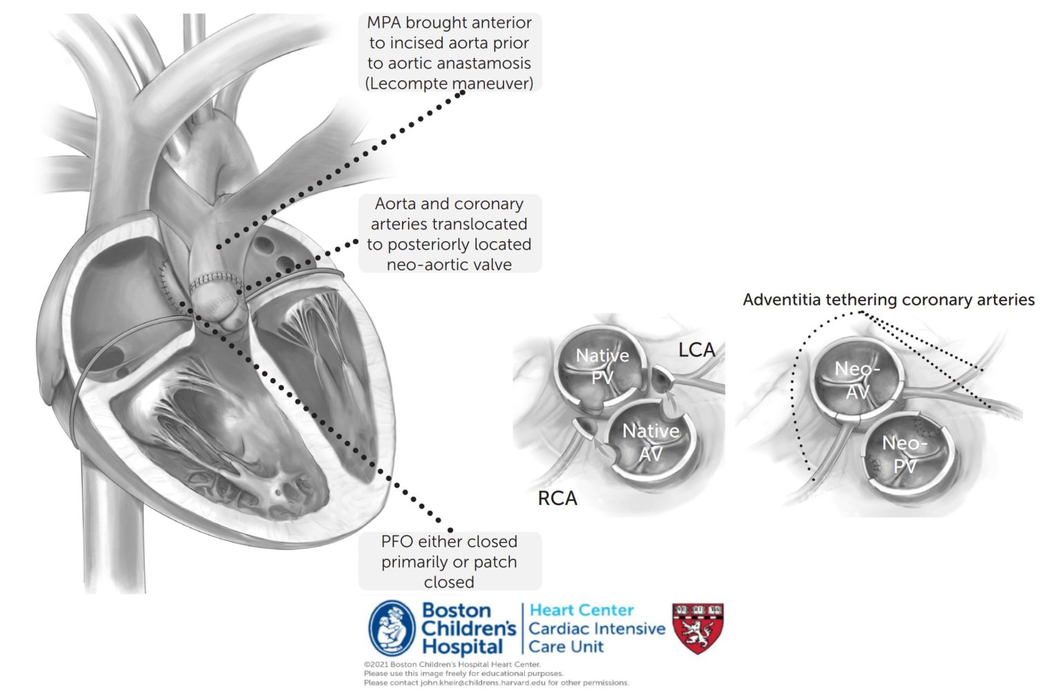 Arterial Switch Operation – Online supplement