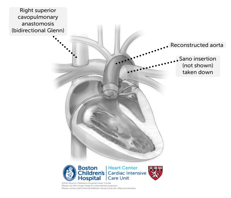 Bidirectional Glenn – Online supplement