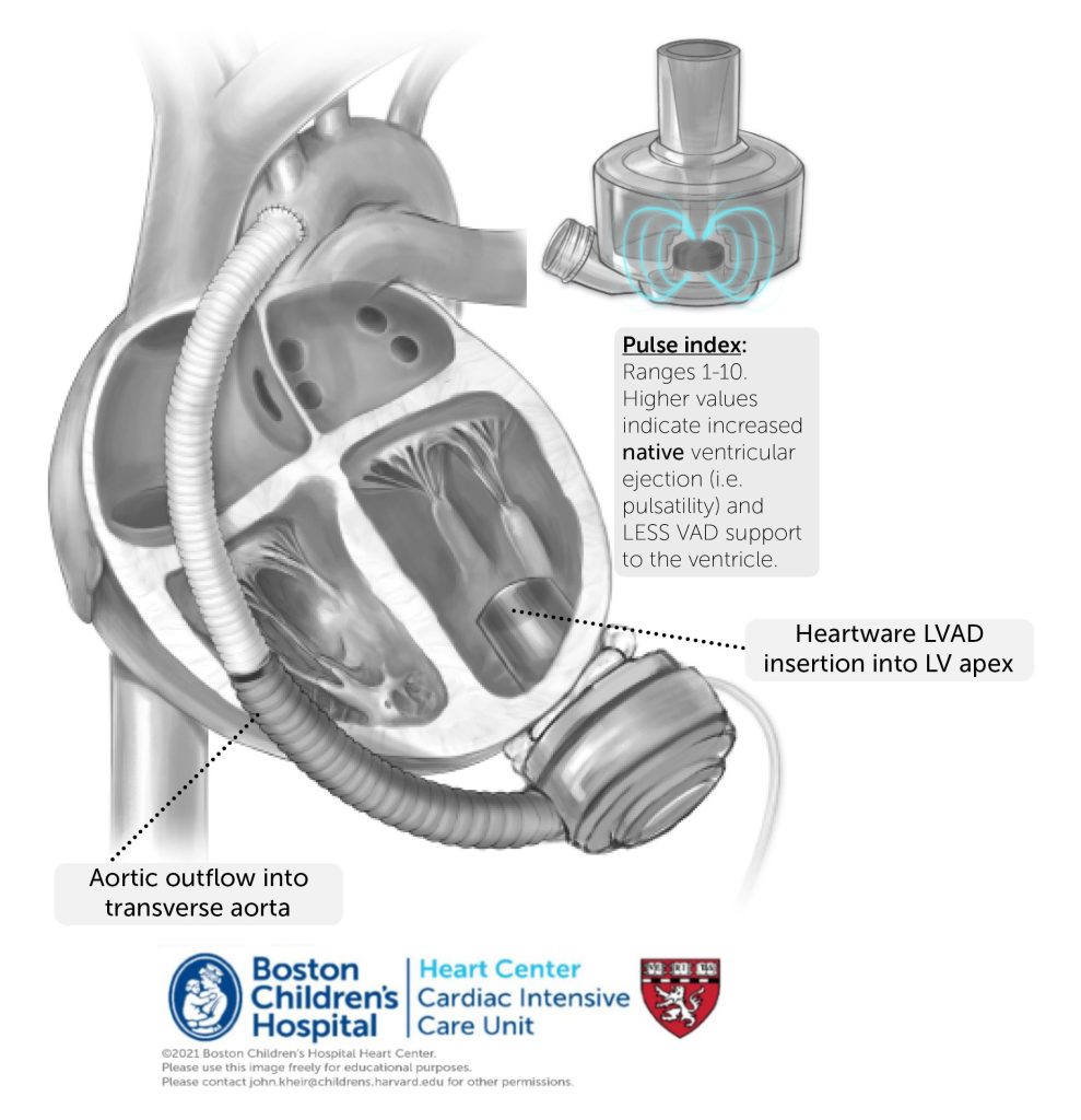 HeartMate III – Online supplement
