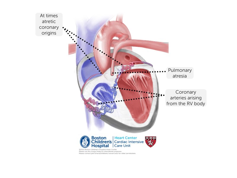 PA/IVS with RVDCC – Online supplement
