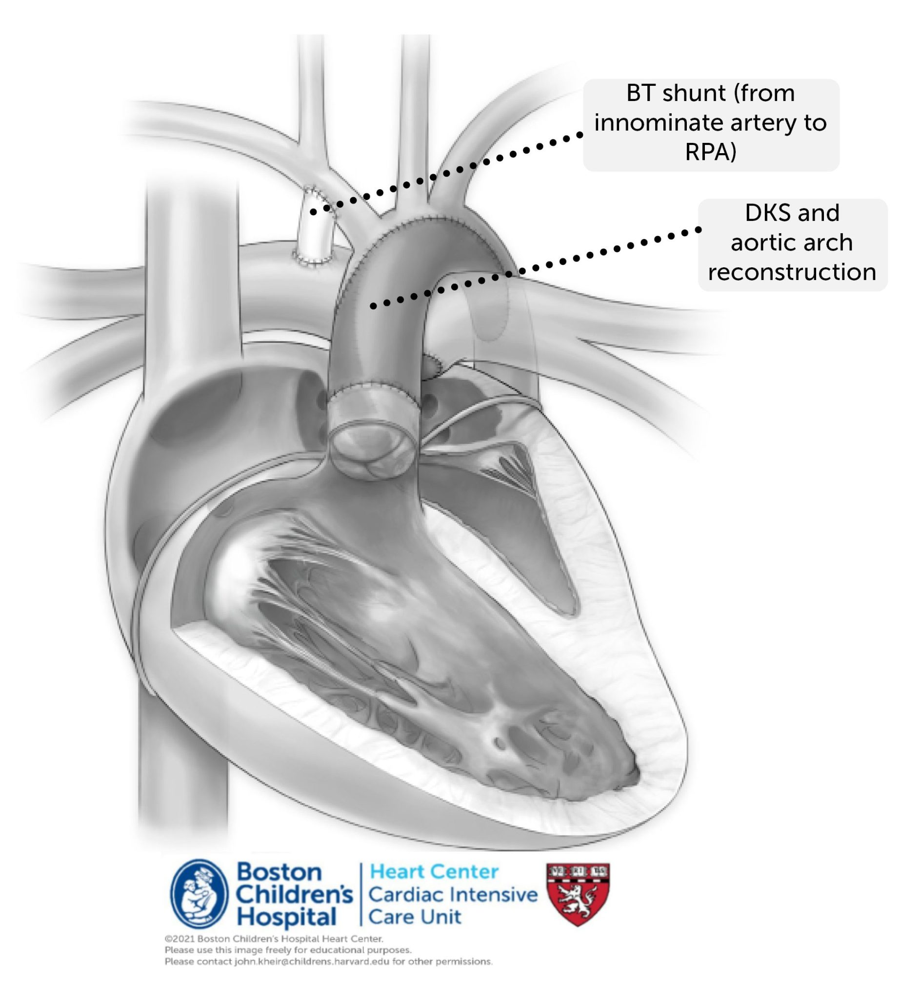 Stage 1 palliation – Online supplement