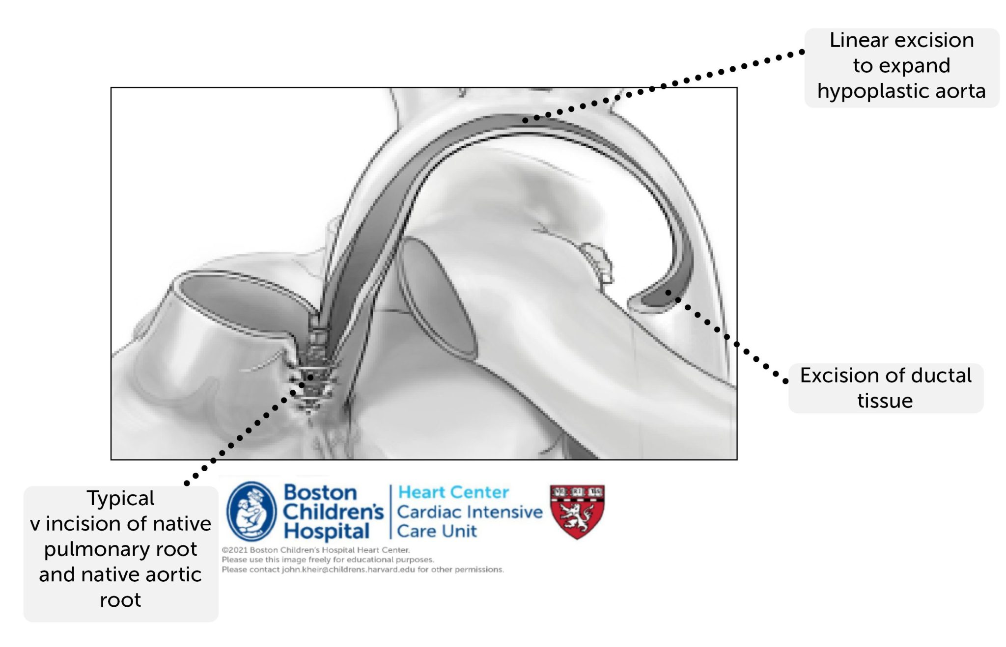 Stage 1 palliation – Online supplement