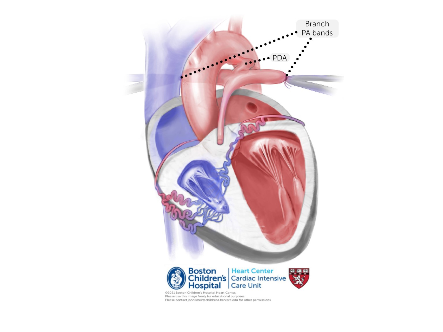 PA/IVS with RVDCC – Online supplement