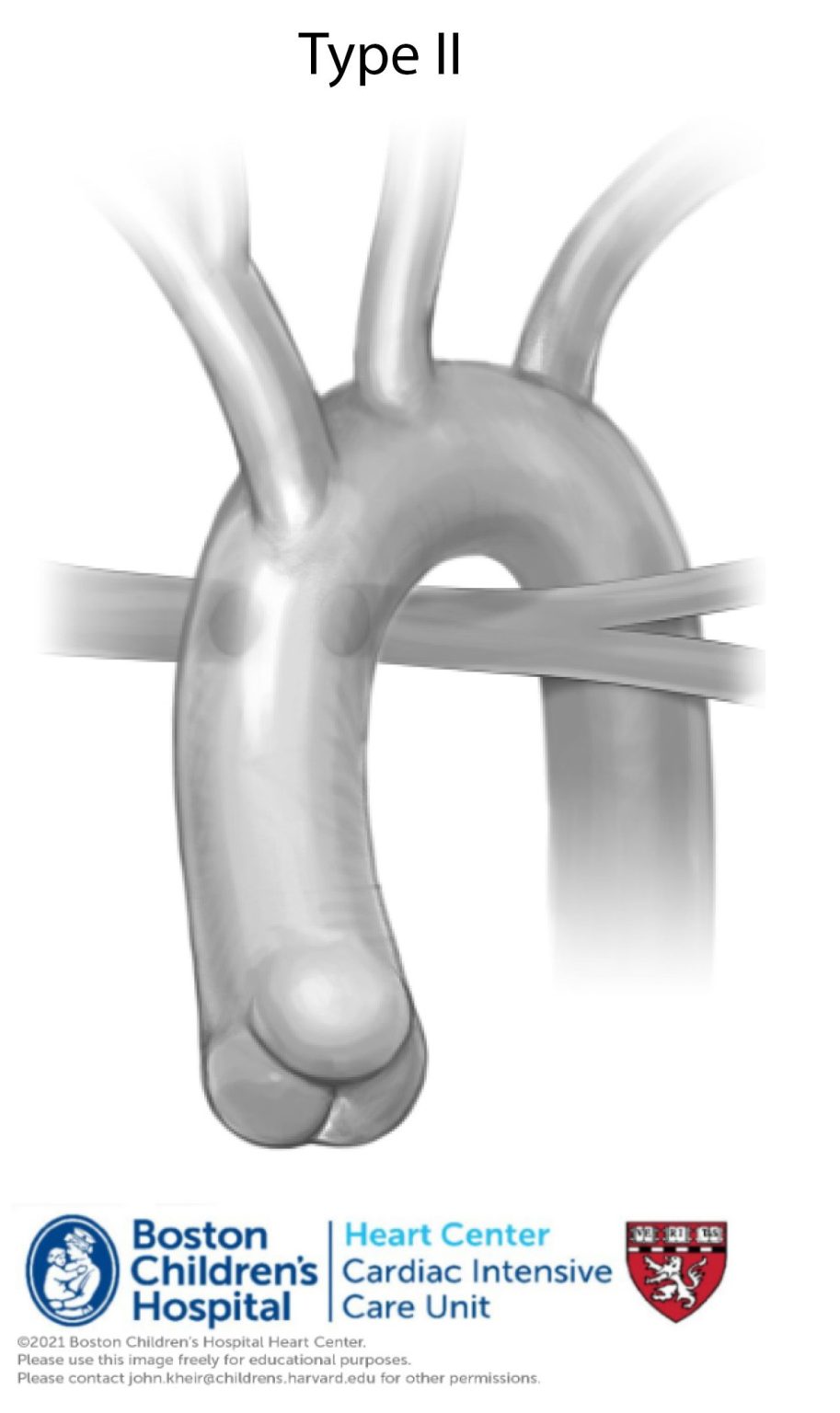 Truncus arteriosus – Online supplement